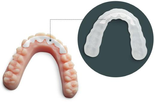 What happens when my Smilers® orthodontic treatment is finished? - Smilers