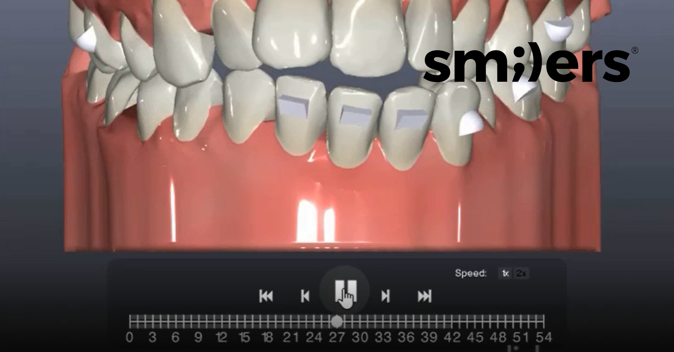 Smilers® Story - Smilers