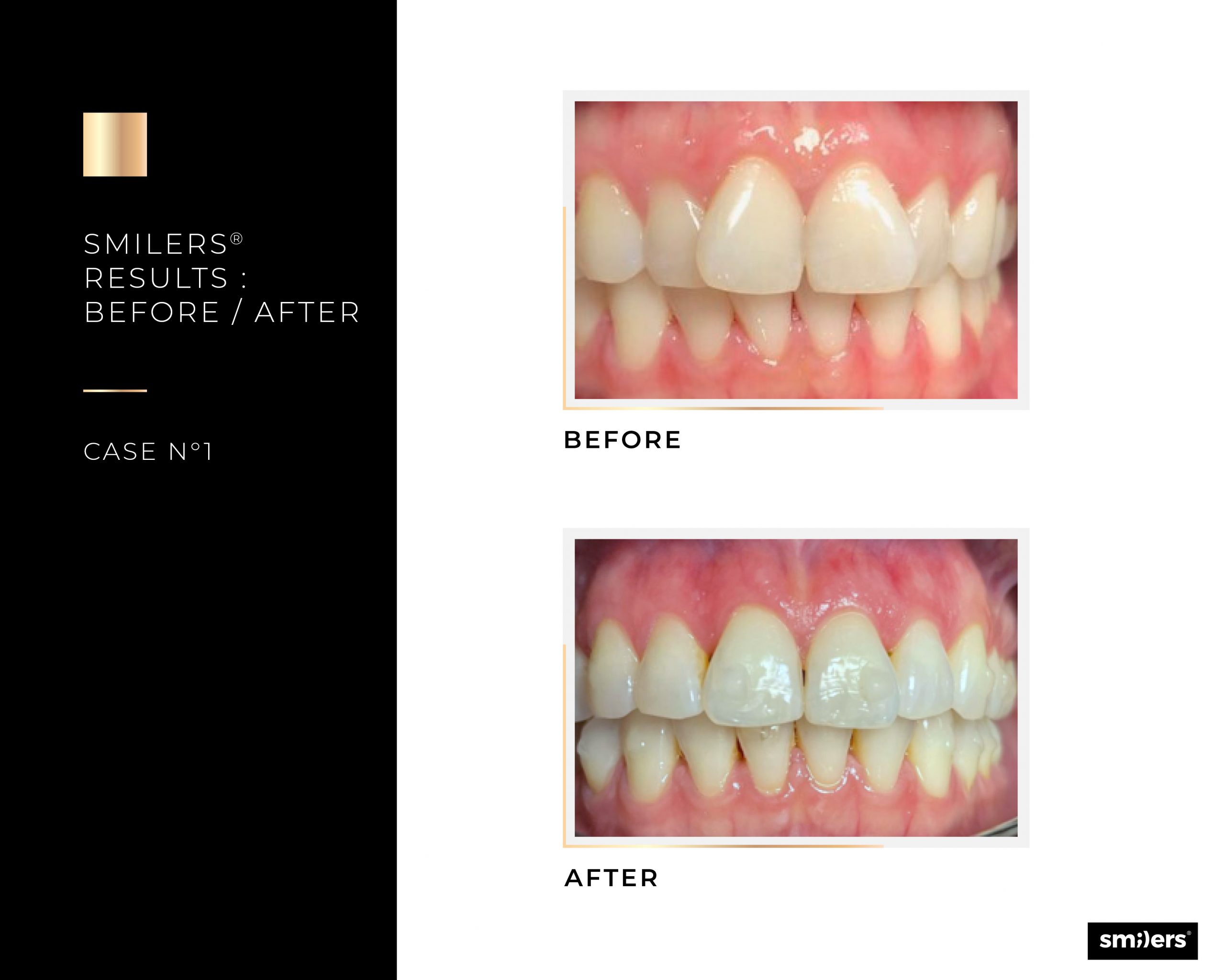 Results and treatable cases - Smilers