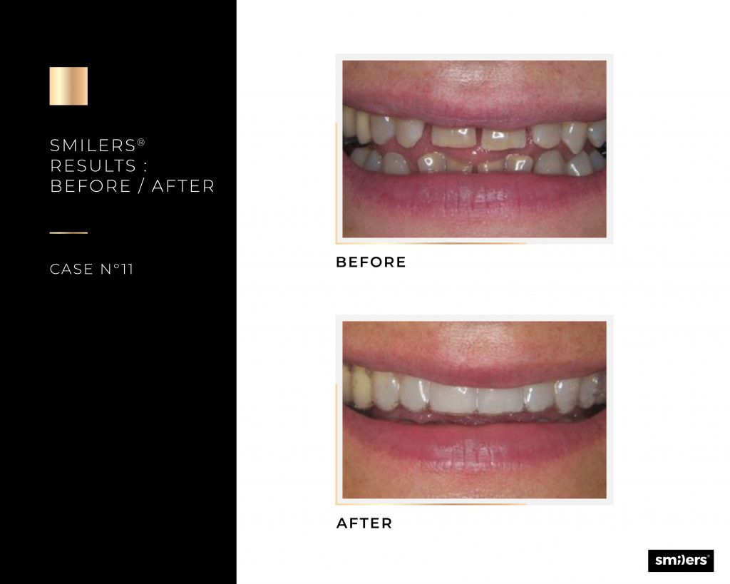 Results before/after - Smilers