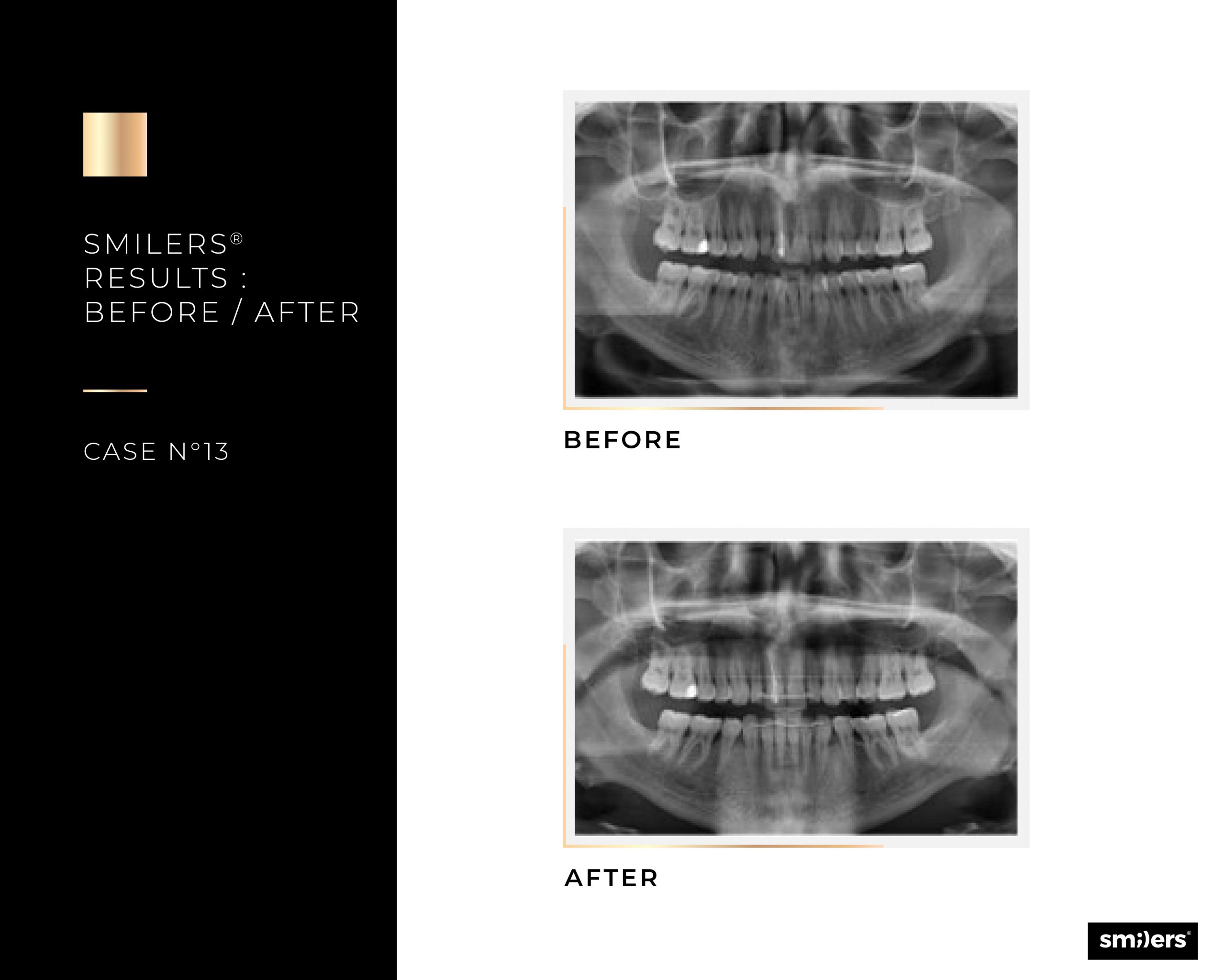Results and treatable cases - Smilers