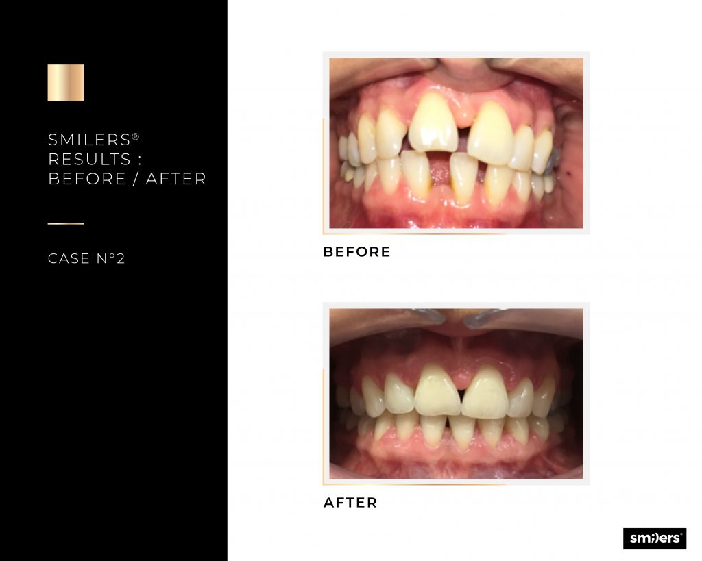 Results before/after - Smilers