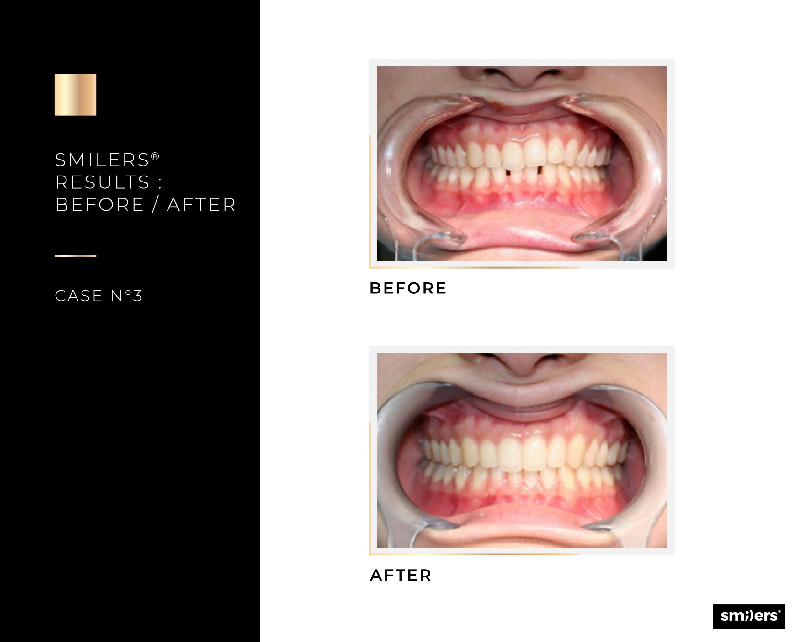 Results before/after - Smilers