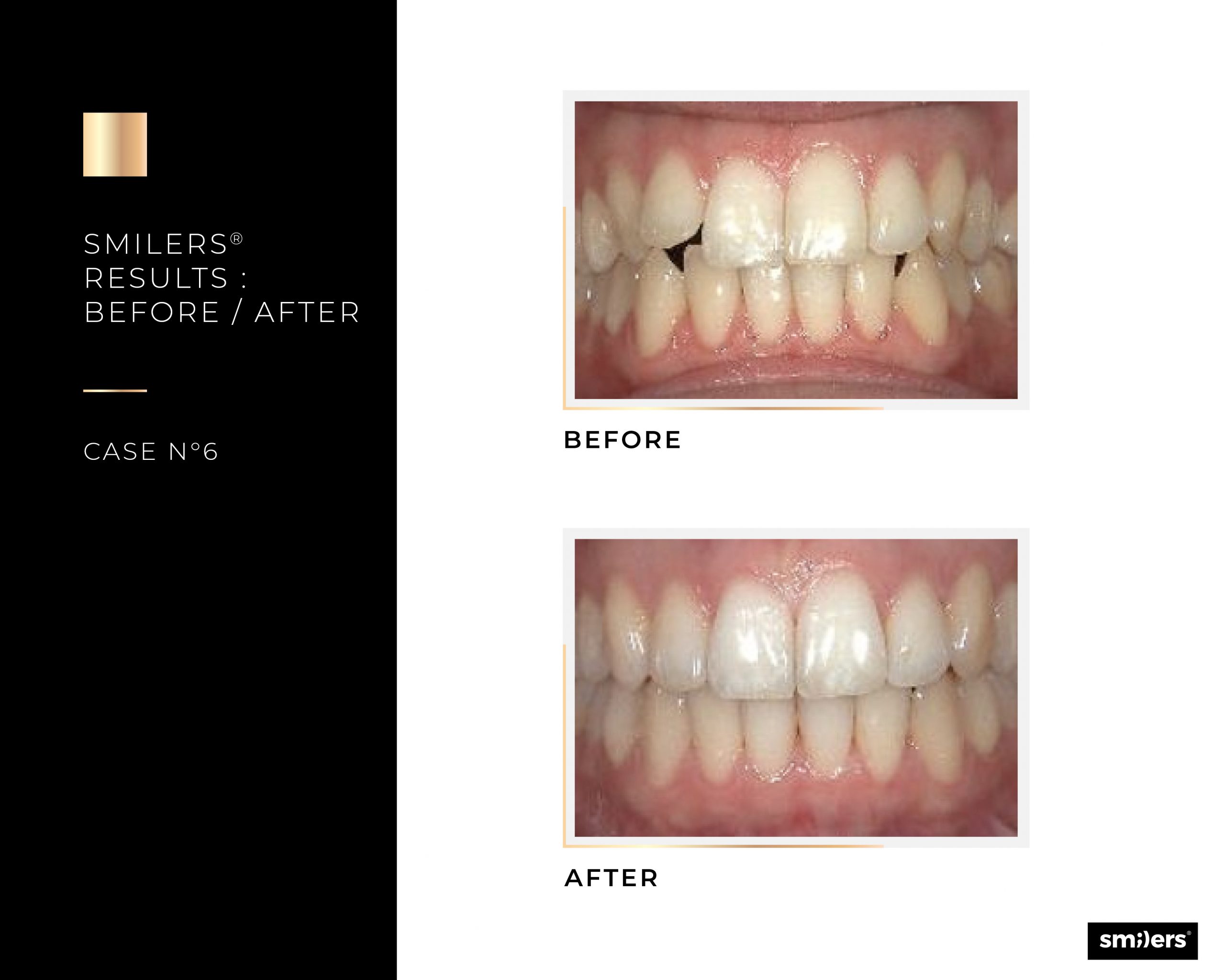 Results and treatable cases - Smilers
