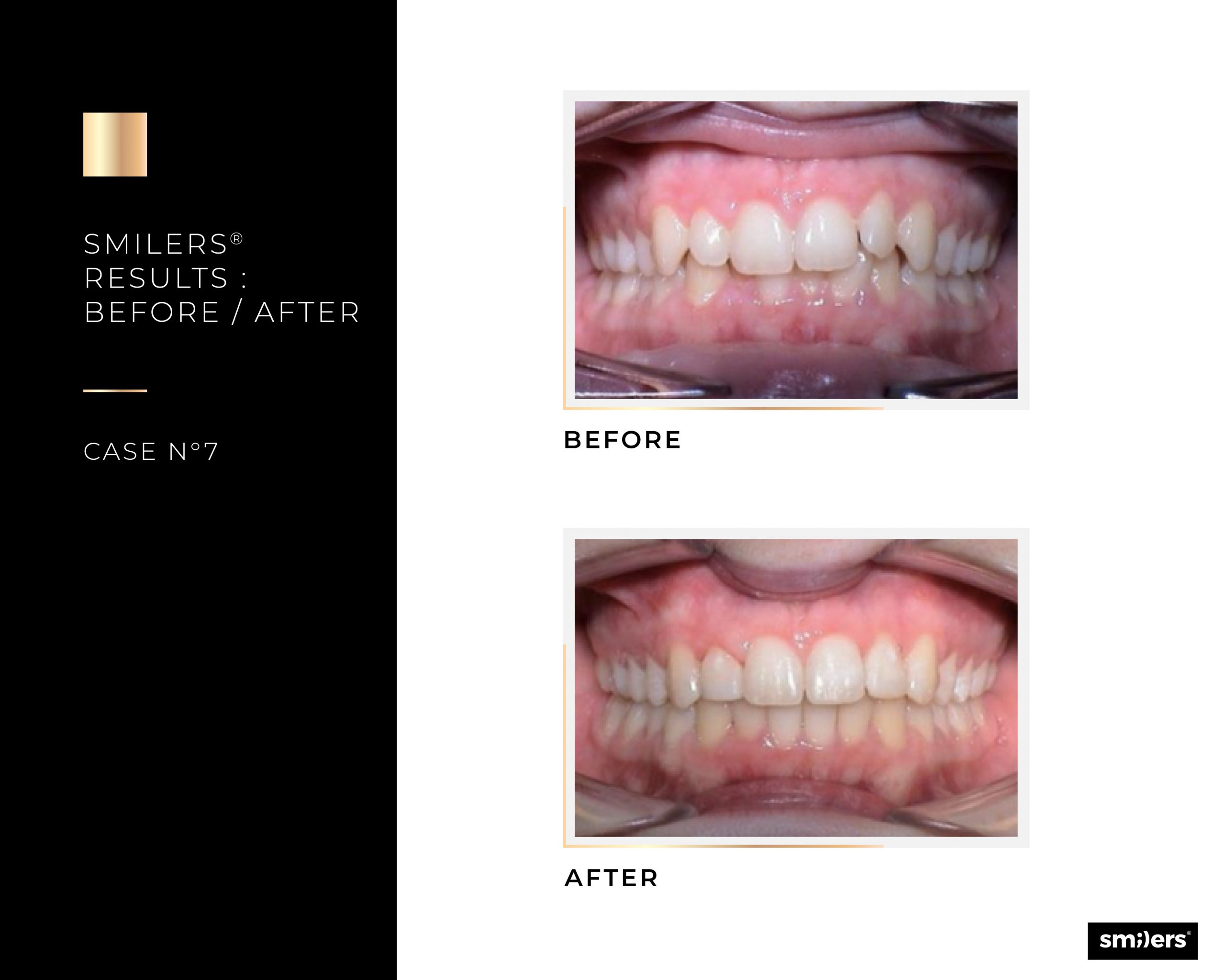 Results before/after - Smilers