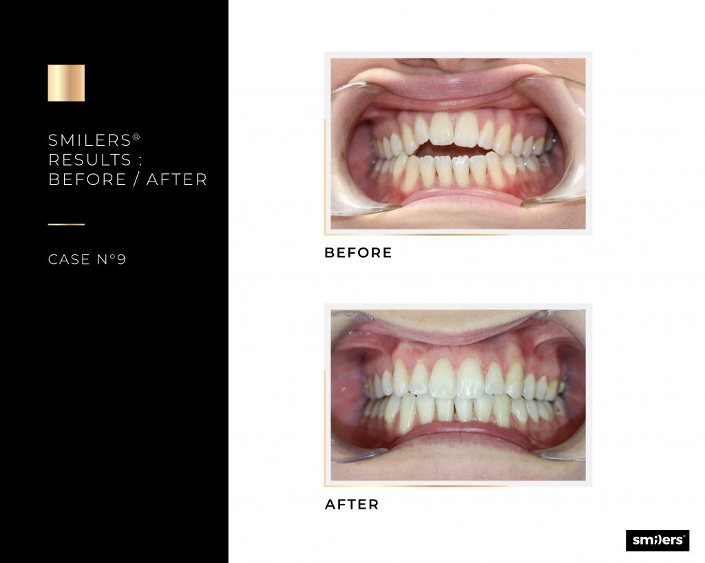 Results and treatable cases - Smilers