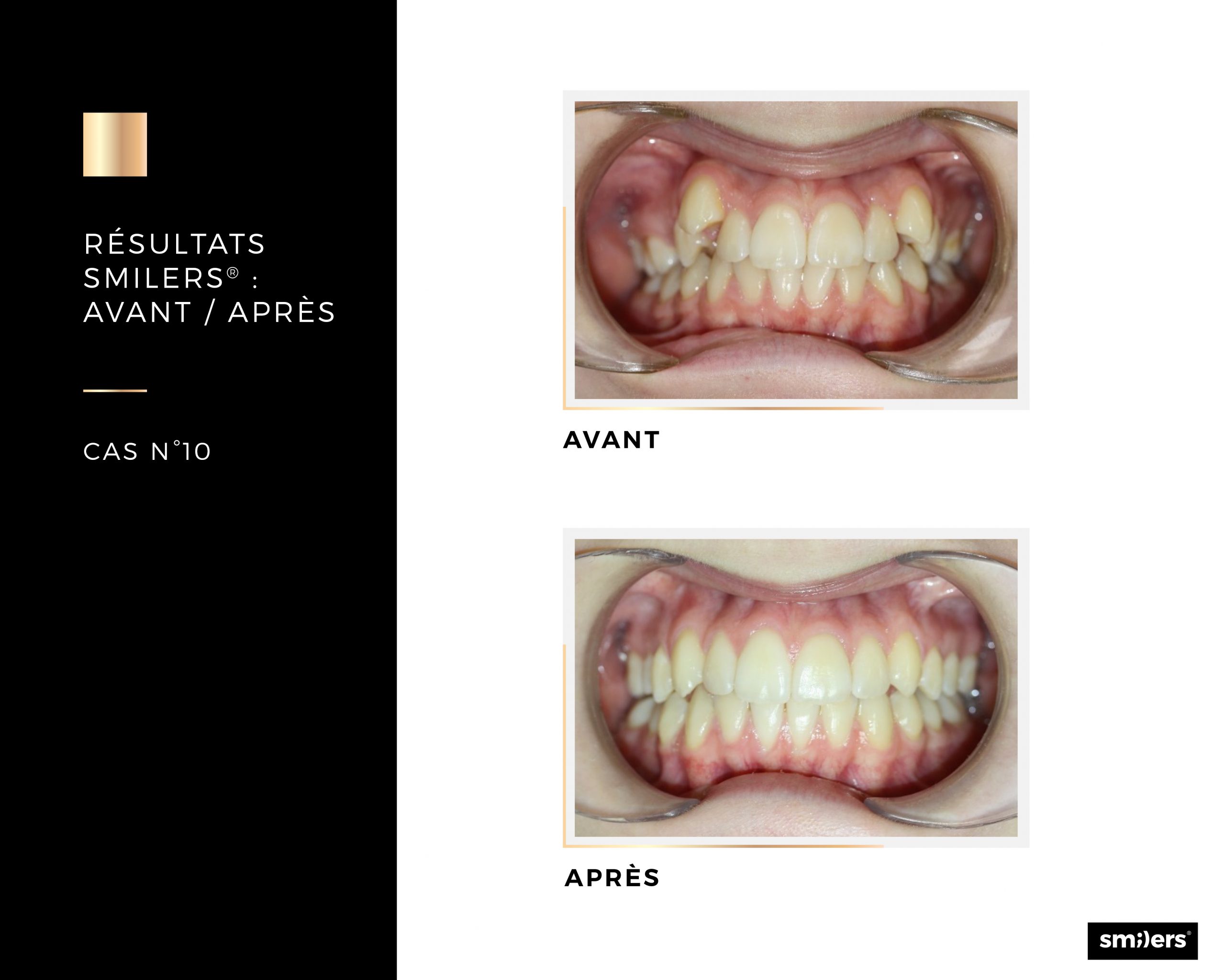 Résultats avant/après - Smilers