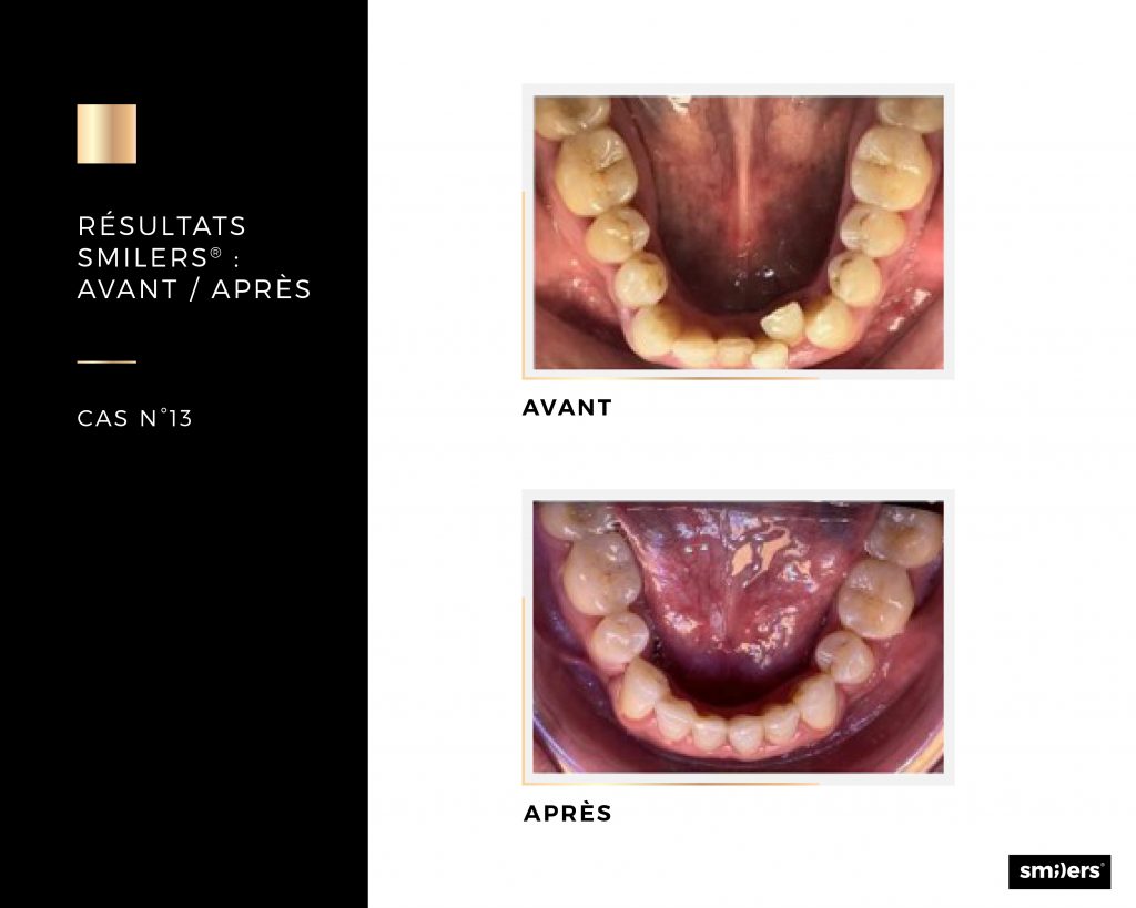 Résultats avant/après - Smilers