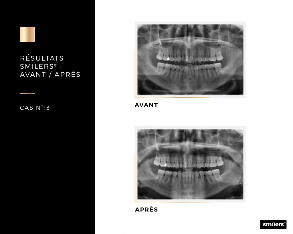 Résultats avant/après - Smilers