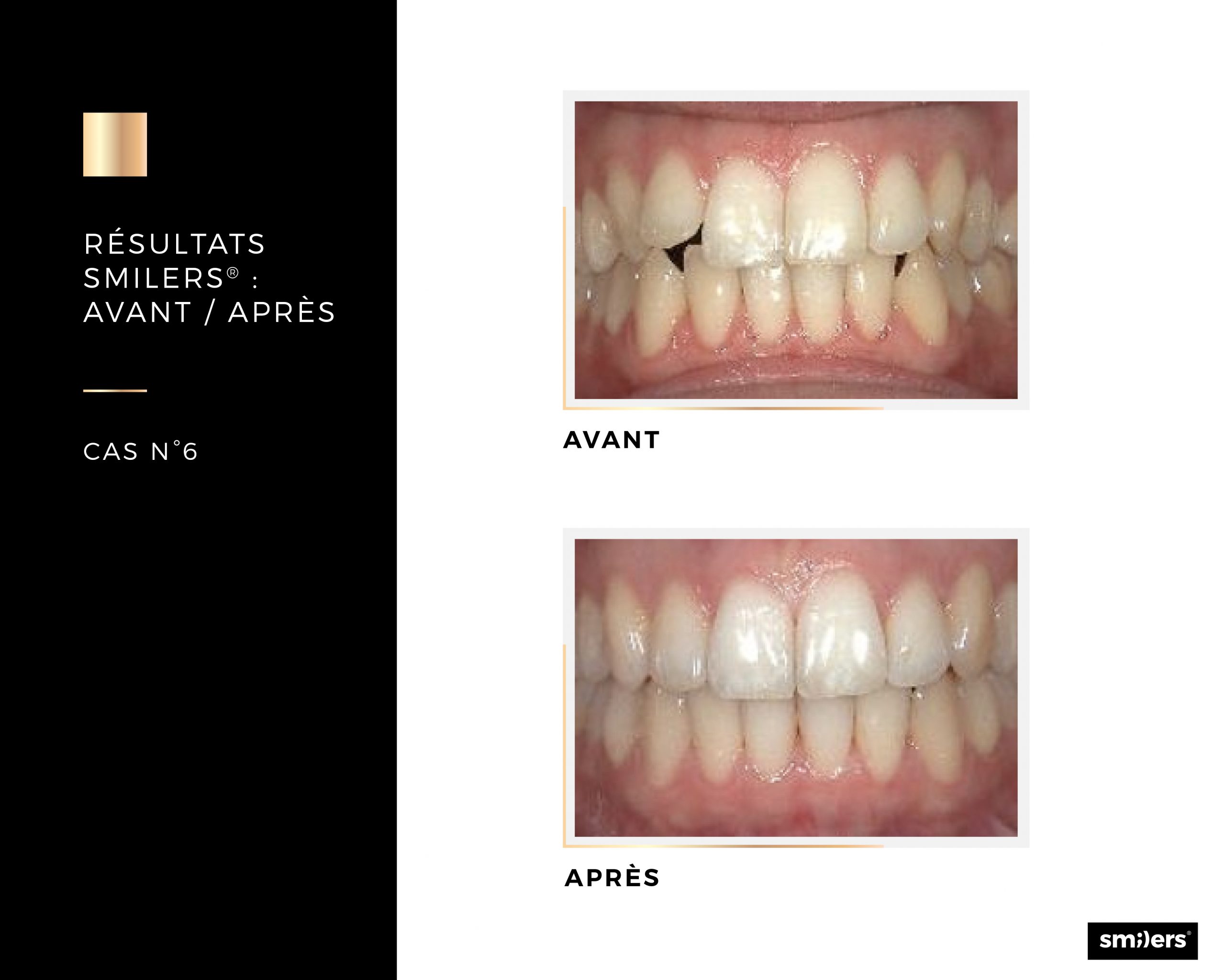Résultats et cas traitables - Smilers