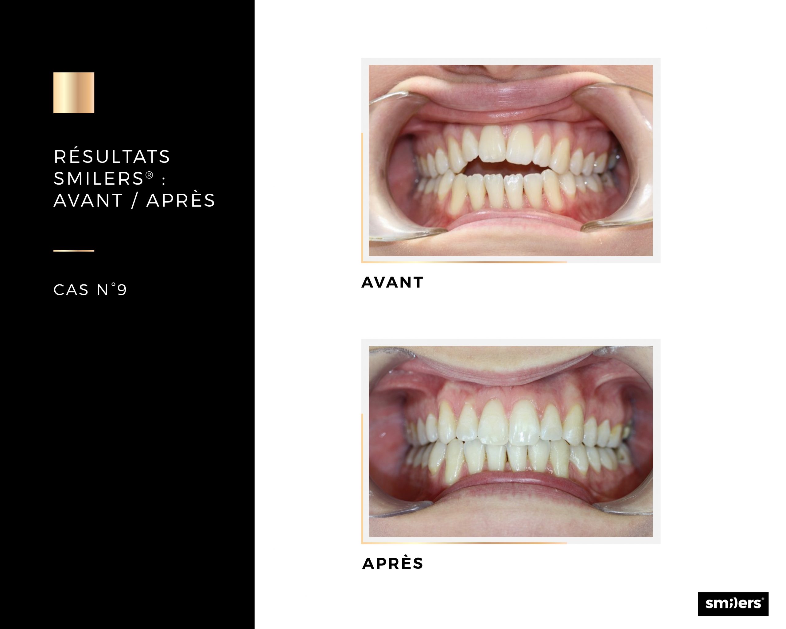 Résultats avant/après - Smilers